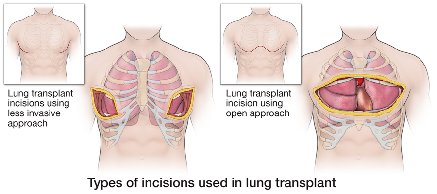 Lung Transplant | Temple Health