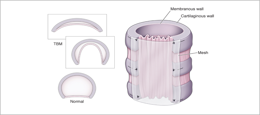 Tracheobronchomalacia: A Rare Lung Disease | Temple Health