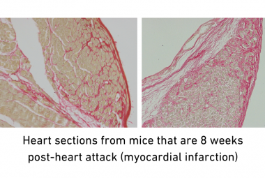 Advanced Heart Failure Treatment Options | Temple Health