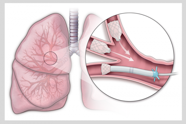 Lung Center | Temple Health