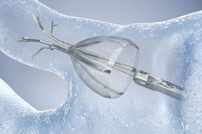 Bronchoscopic Lung Volume Reduction Procedure | Temple Health