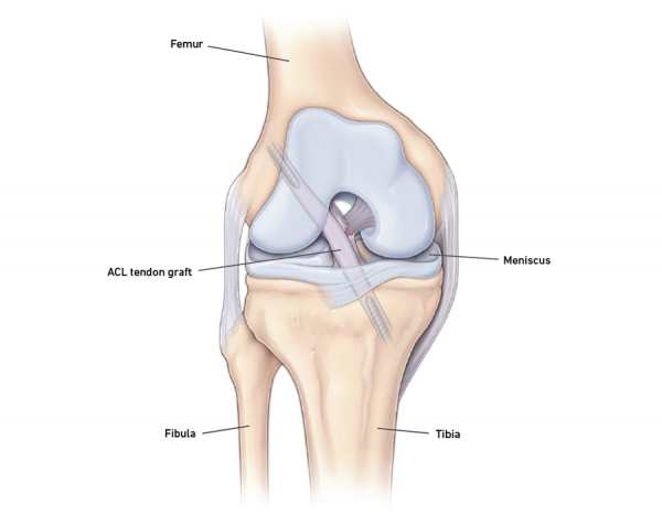 ACL Reconstruction Surgery | Temple Health ACL Reconstruction Surgery | Temple Health
