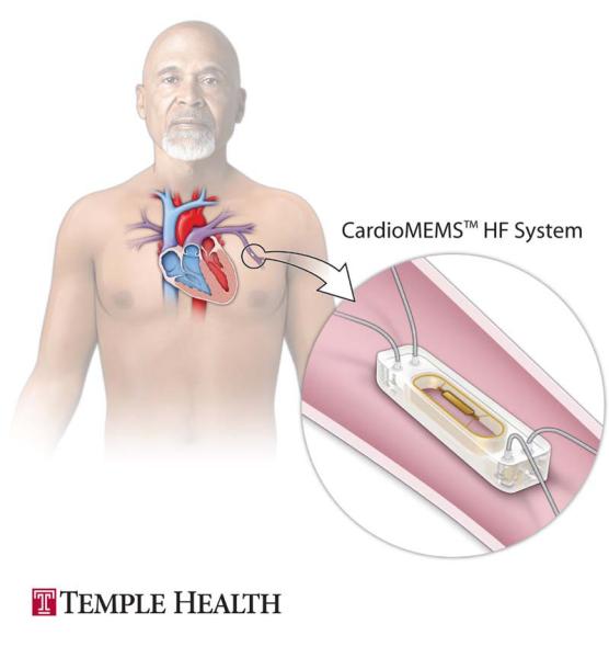 CardioMEMS Device for Monitoring Advanced Heart Failure: 5 Things to Know