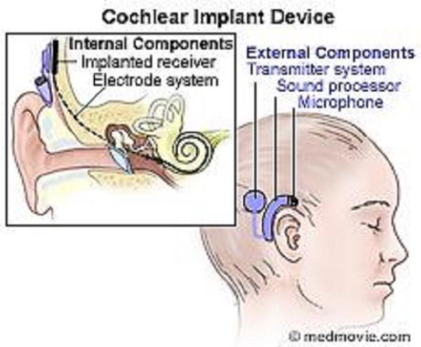 Cochlear Implants: How Are They Different from Hearing Aids? | Temple ...