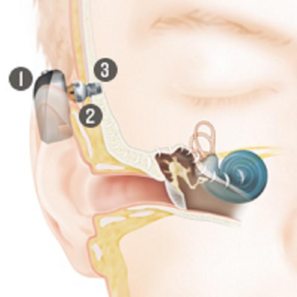 Bone Anchored Hearing Systems: How They Work