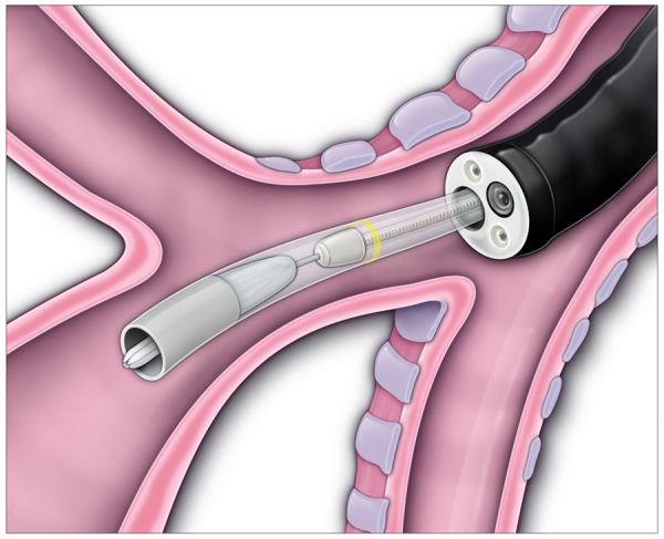 Bronchoscopic Lung Volume Reduction Using Endobronchial Valves | Temple ...